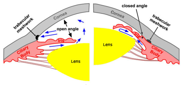 Ch 9. Glaucoma Emergency: Acute angle closure glaucoma. A Patient's Guide to Glaucoma